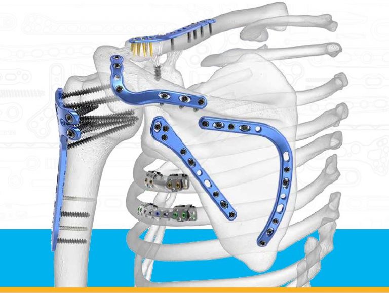 Shoulder Girdle and Chest Wall Solutions | Acumed Information